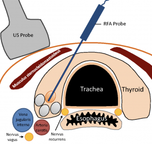 Thyroid RFA vs. Conventional Thyroidectomy